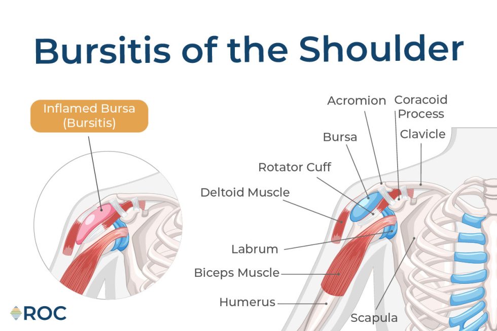 Understanding Bursitis of the Shoulder: Causes, Symptoms, and Treatment ...