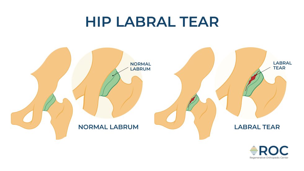 Pros and Cons of Labral Tear Surgery: Insights from Hip Specialist Dr ...