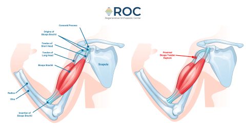Proximal Biceps Tendon Injuries: Is Surgery Necessary? - ROC PDX