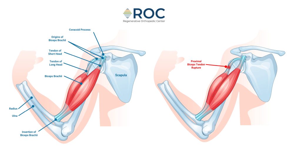 Proximal Biceps Tendon Injuries: Is Surgery Necessary? - ROC PDX