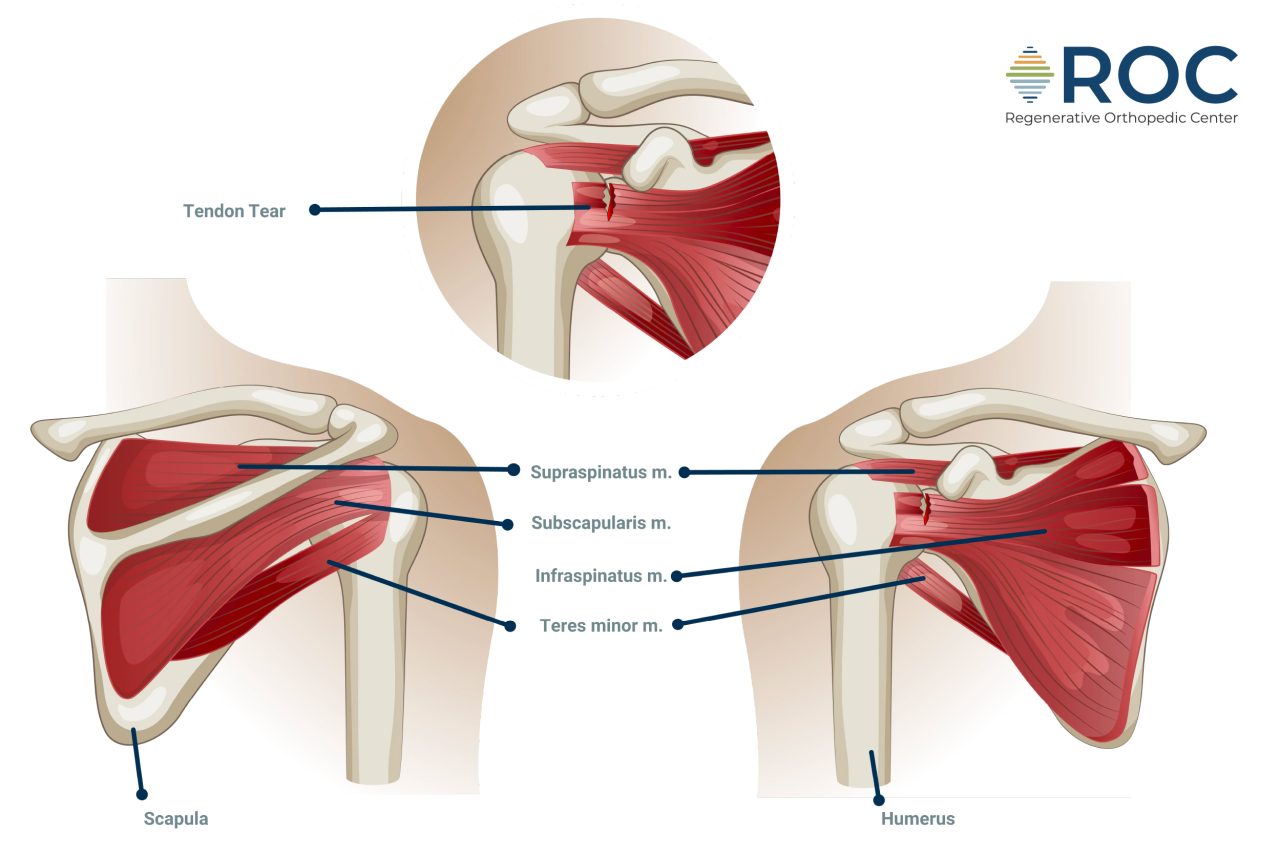 When Can I Drive After Rotator Cuff Surgery? - ROC PDX